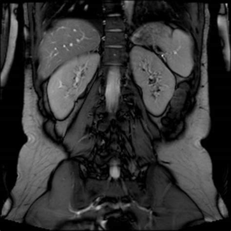Post Mortem Mri A Viable Alternative To An Autopsy Ucl News Ucl University College London