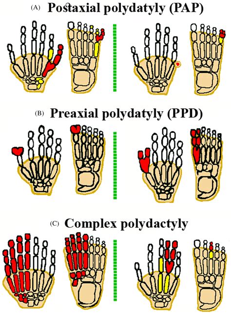Postaxial Polydactyly