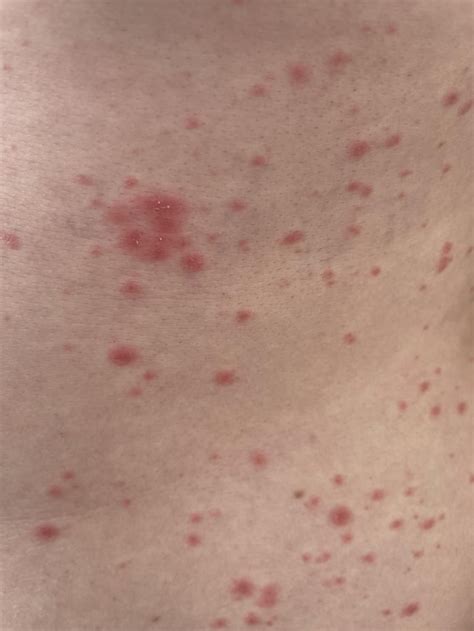 Whole Body Rash After Taking Doxycycline R Dermatologyquestions