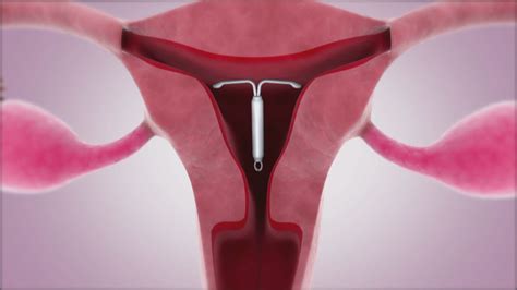 Iud Most Effective Birth Control Method Canadian Pediatricians Declare Cbc News