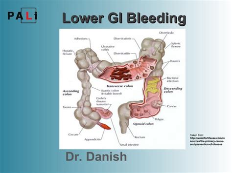 Lower Gi Bleeding 3 April Dr Danishppt