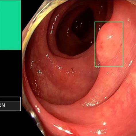 Detection Of A Colorectal Polyp By The Endoaid Computer Aided Detection