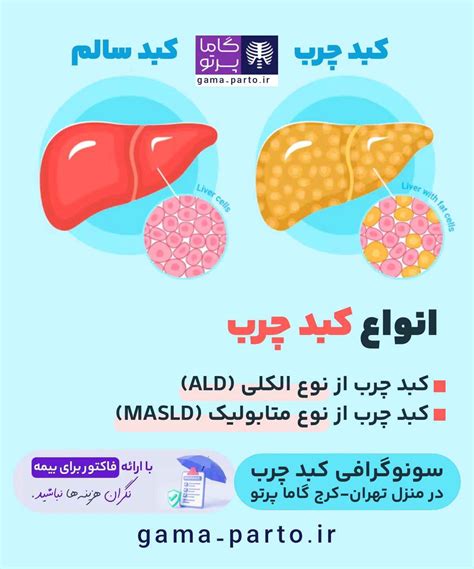 بیماری کبد چرب چیست؟ اینها علائم کبد چرب هستند به شدت مراقب باشید