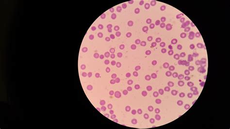 How To Use The Malaria Infection Object Detection Api