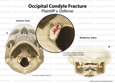 Occipital Condyle Fracture Motionlit