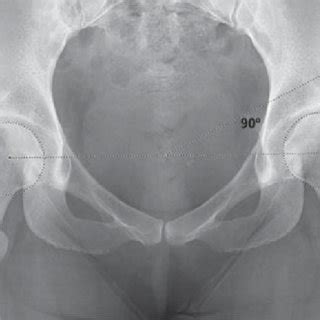 Year Old Man With Normal Left Center Edge Angle Anteroposterior Pelvic Download Scientific