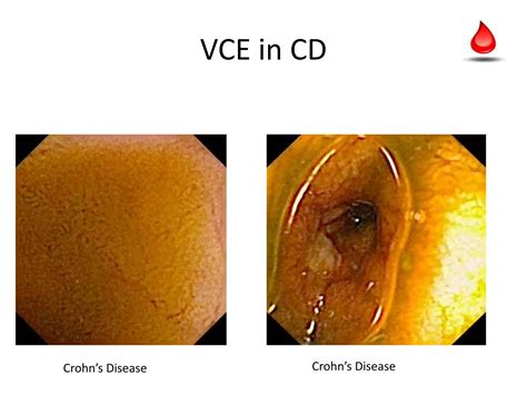 small bowel round table vce ppt