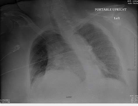 Chest X Ray With Anteroposterior View Revealing Bilateral Interstitial Download Scientific