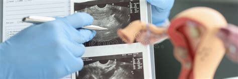 Female Doctor Pointing At Ultrasound Analysis Of Ovary Transvaginal