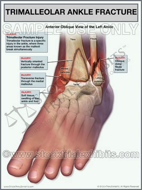Ankle Fracture Trimalleolar Fracture Of The Left Ankle Ankle