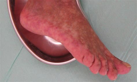 Purple Toes Symptom