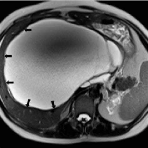 Ultrasound Scan Of The Huge Liver Cyst Figure 2 Mri Demonstrating The Download Scientific