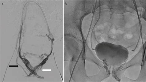Endovascular Management Of Priapism And Erectile Dysfunction