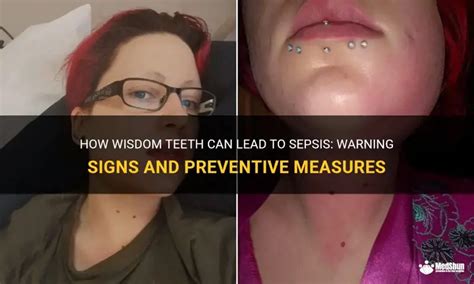 How Wisdom Teeth Can Lead To Sepsis Warning Signs And Preventive