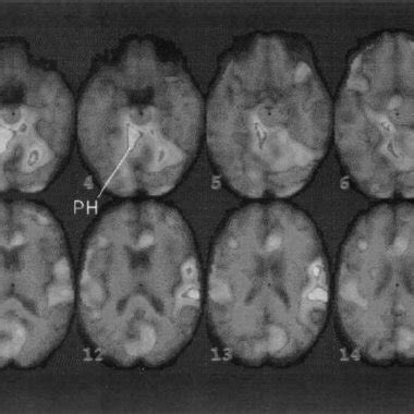Statistical Parametric Map Of Areas Of Significant Interaction Between Download Scientific