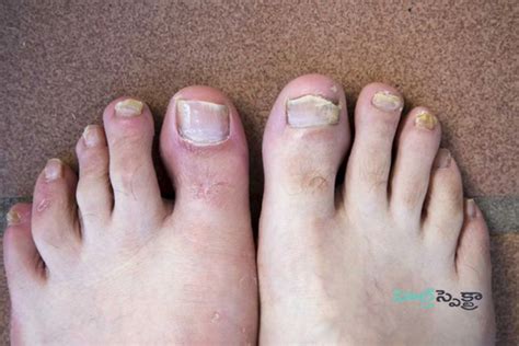 Paronychia Nail Infection Symptoms And Treatment