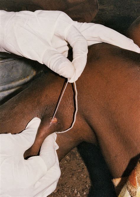 Guinea Worm Disease Definition Infection Treatment And Eradication Britannica