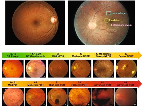 Assessing And Grading Diabetic Retinopathy Updates For Ophthalmology