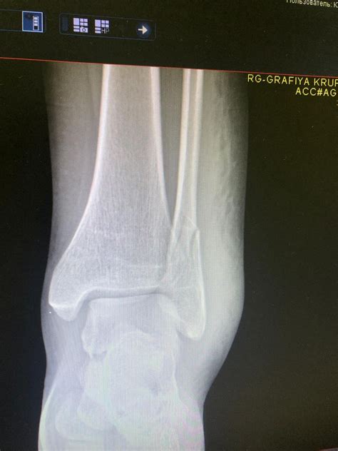 Почему не сросся перелом лодыжки? - Вопрос ортопеду-травматологу - 03 ...