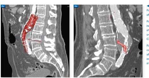 Figure 2 From Translumbar Type Ii Endoleak Embolization Using Real Time