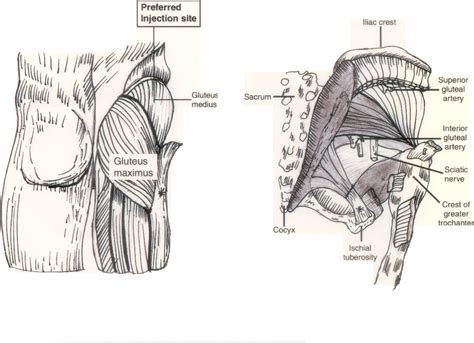 Gluteal Injection Site Buttock Injection Practice Model Training Tool