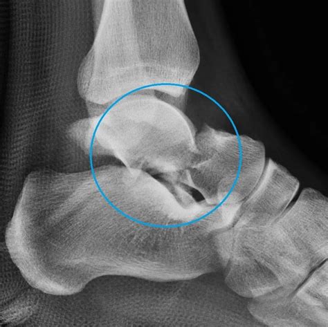 Tatus Fractures Dr Ben Beamond Adelaide
