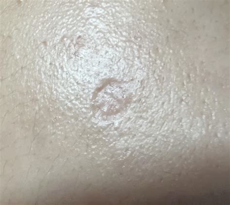 what treatment can smoothen this out r acnescars