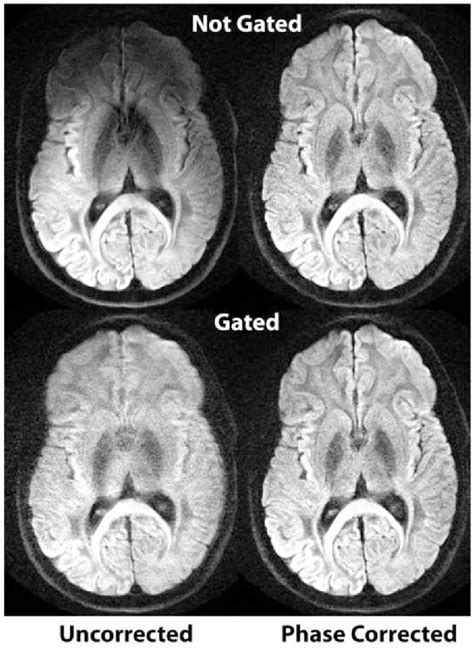 Figure 3 From Readout Segmented Epi For Rapid High Resolution Diffusion Imaging At 3 T
