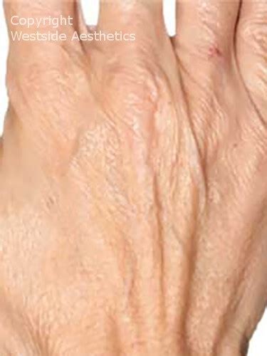 Los Angeles Aging Hands Treatment Santa Monica Reverse Aging Hands