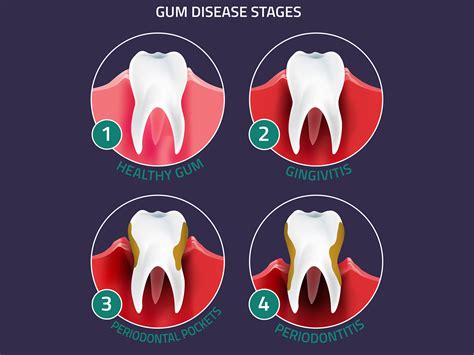 Gum Disease Stages