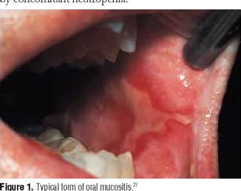 Chemo Mucositis