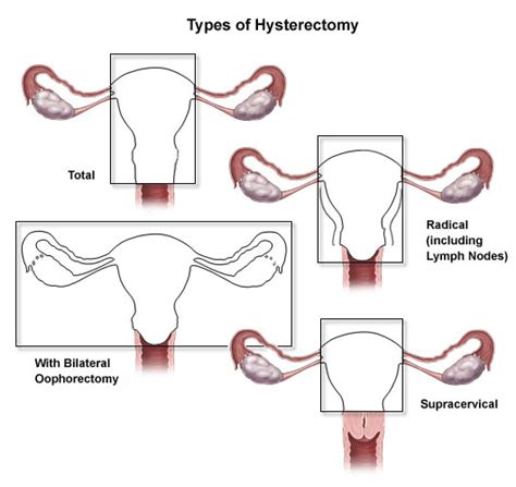 Hysterectomy Diagram Hysterectomy Complications Infographic