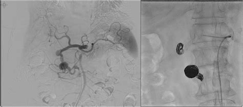 Coil Embolization Performed Using Detachable Coils Download Scientific Diagram