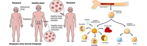 Bone Marrow Transplant Cost In India From Best Doctor