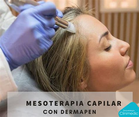 Clinimedic La Mesoterapia Capilar Es Un Tratamiento No