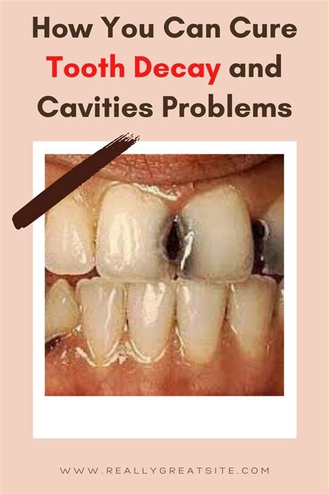 Fix Tooth Decay And Receding Gums Artofit