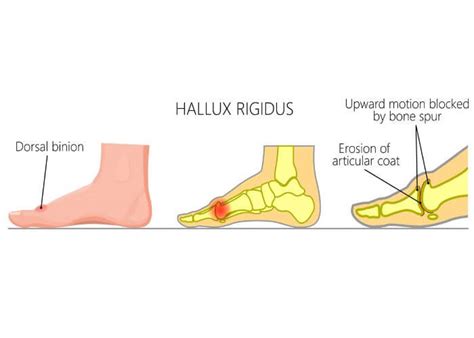Hallux Rigidus Anatomy