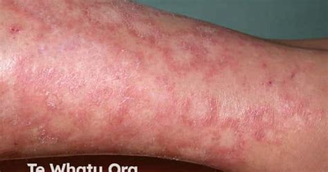 Erythema Annulare Centrifugum Image