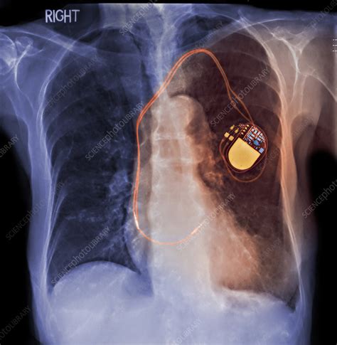 Implantable Defibrillator Pacemaker Stock Image C004 7524 Science Photo Library