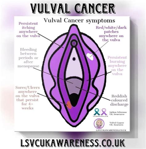 Vulva Lumps Pictures Benign Cysts In The Vulva Psflm