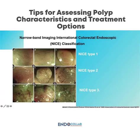 ⚕️ Polyp Assessment Guide Nice Classification System ⚕️ Quickly