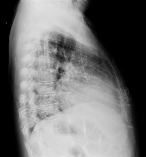 110lu Nsip And Scleroderma Probable Fibrotic Form The Common Vein