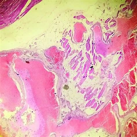 Histopathology Showing Intramuscular Hemangioma Discussion Hemangiomas
