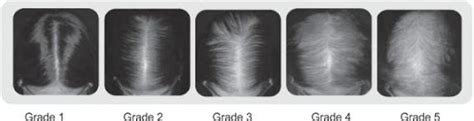 Female Hair Loss Treatments Dallas Sophia Michelle