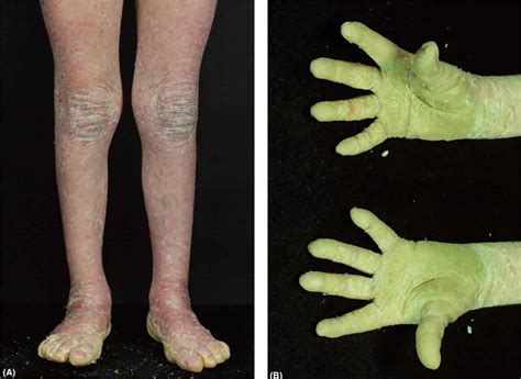 Epidermolytic Hyperkeratosis Causes Symptoms Diagnosis And Treatment