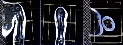 Magnetic Resonance Angiography Mra Upper Arm Protocols And Planning