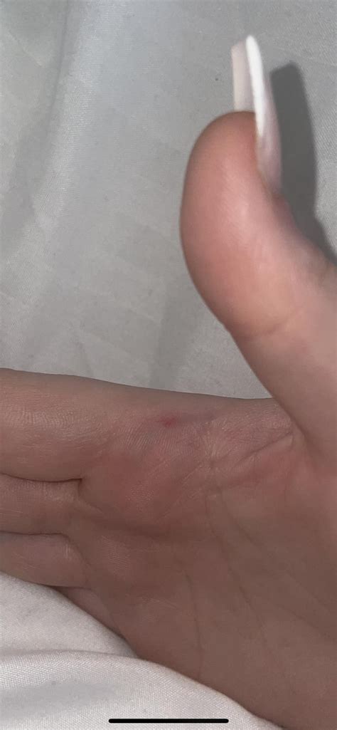 Red Graze Like Patch On Hand R Scleroderma