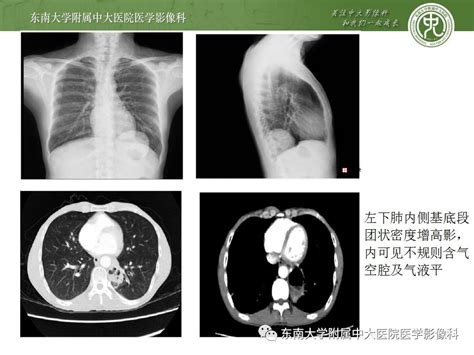 肺隔离症影像表现附病例 医学界 助力医生临床决策和职业成长