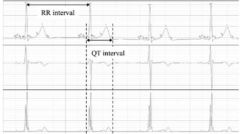 Measurement Of Rr Interval And Qt Interval The Ecgs Were Recorded By