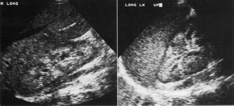 Diffuse Liver Disease Flashcards Quizlet